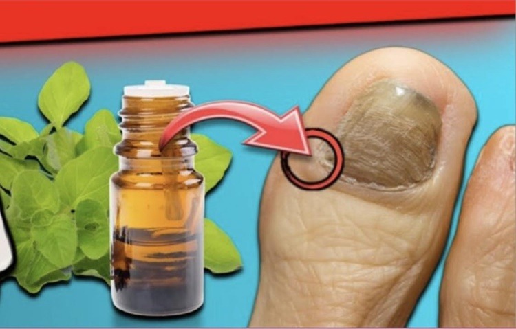 Jak účinně léčit plísňové infekce a infekce nehtů: Rychlá a přírodní ...